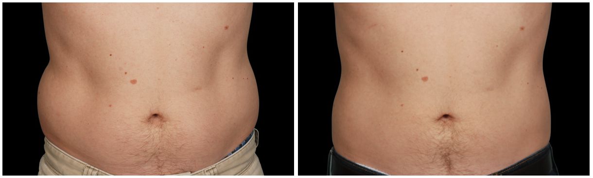 CoolSculpting® | Santa Rosa, CA | Lela M. Emad, MD, FACOG